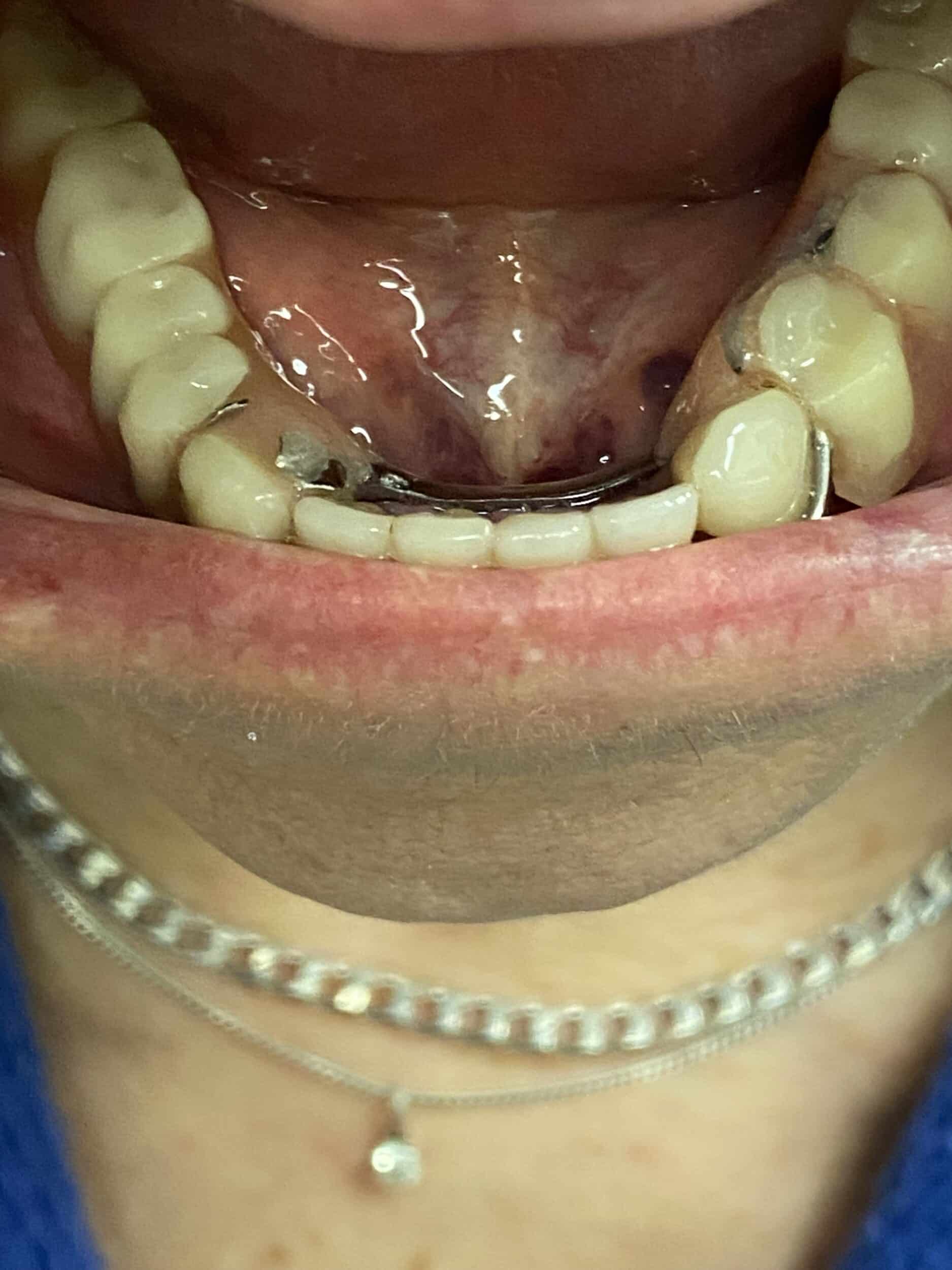 Implant Supported Dentures Montreal QC - Overdentures QC