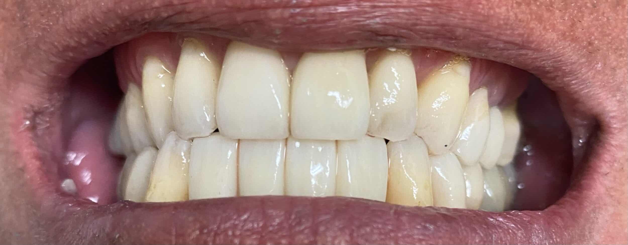 Dental Bridges Montreal - Dr. Lenny Slepchik