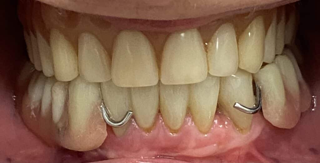 Implant Supported Dentures Montreal QC - Overdentures QC