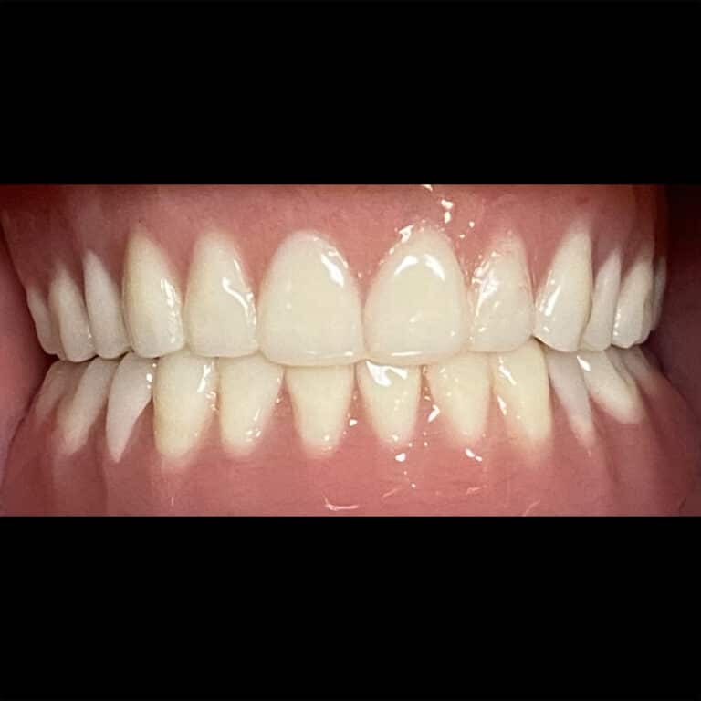 Full Mouth Restoration Archives - Lenny Slepchik DDS