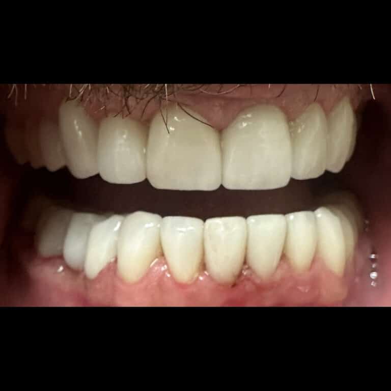 Full Mouth Restoration Before & After Gallery: Case 3936 - Lenny ...